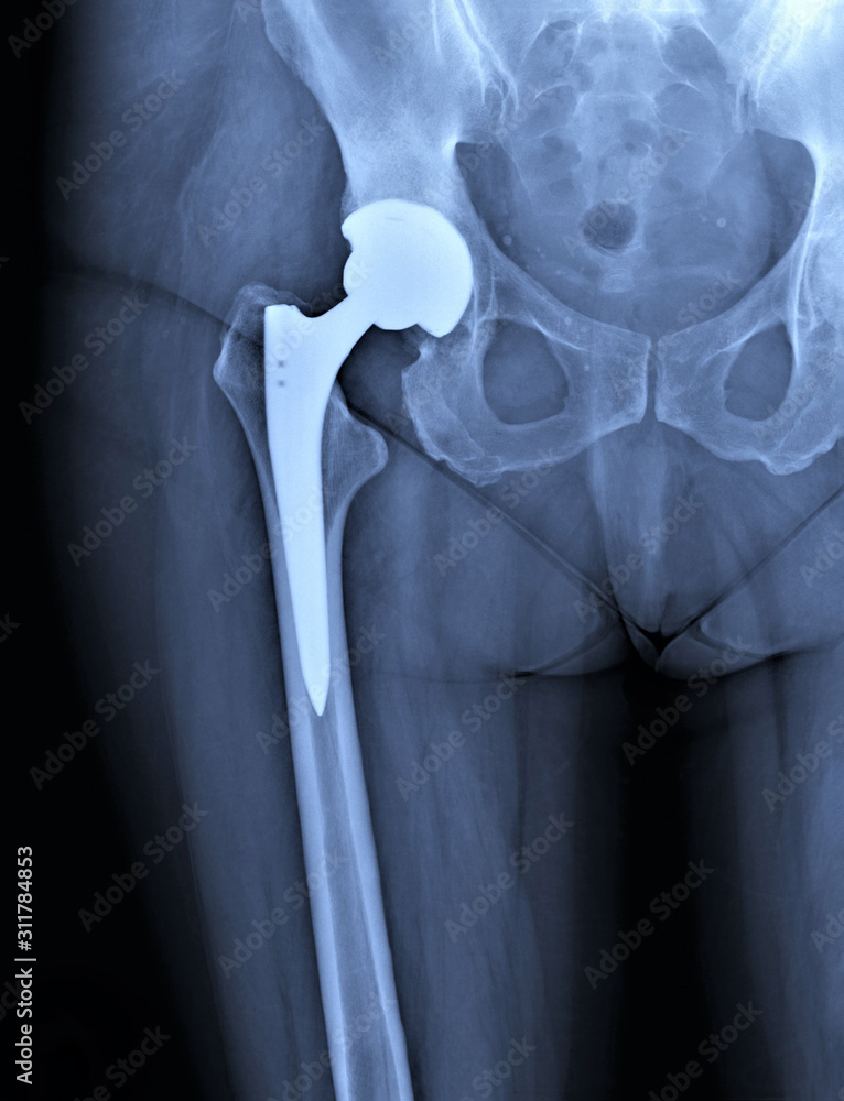 x-ray of hip replacement,implantation, orthopedics Stock Photo | Adobe ...
