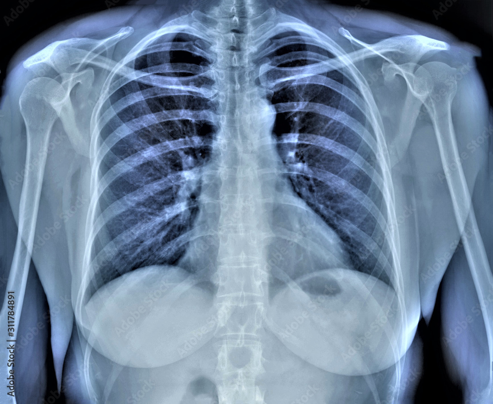 normal radiography of chest organs in direct projection, traumatology ...
