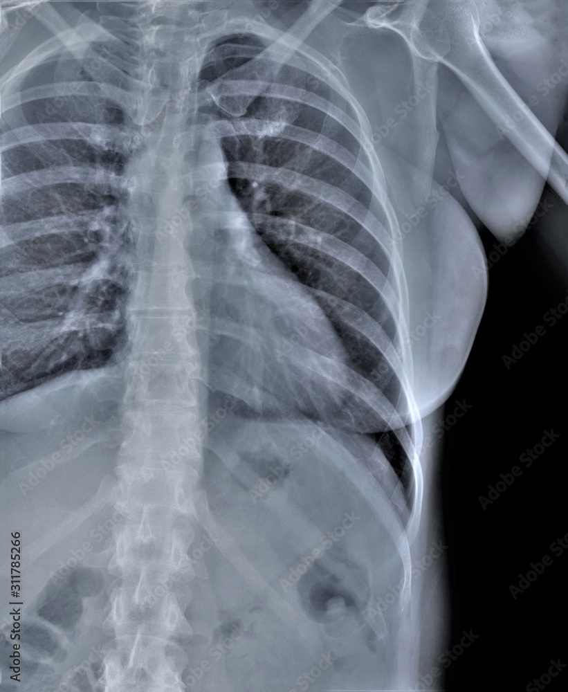 normal radiography of chest organs in direct projection, traumatology ...