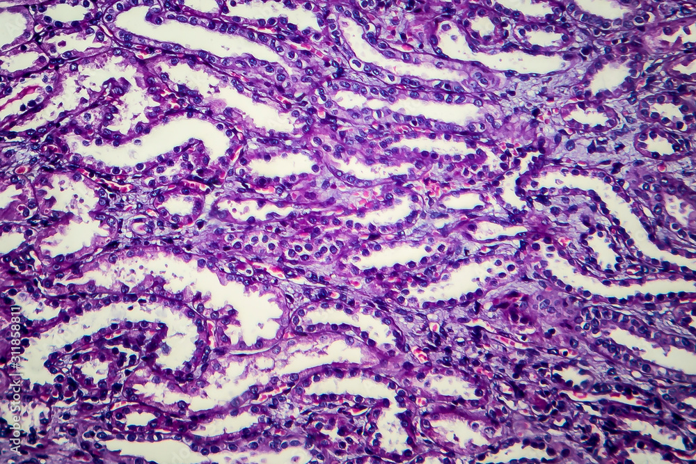 Chronic nephritis, light micrograph, photo under microscope Stock Photo ...