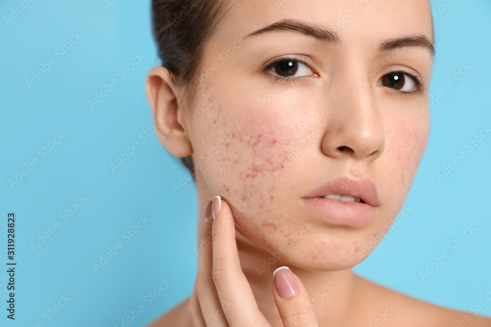 Teen girl with acne problem on light blue background Stock Photo ...