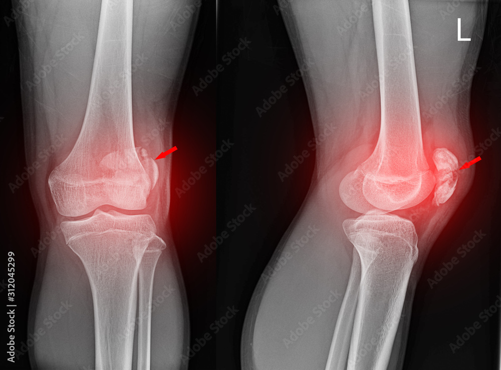 Knee joint x-ray fracture patella. Stock Photo | Adobe Stock