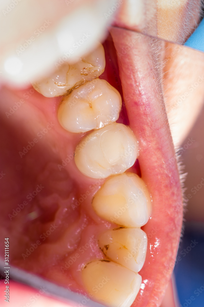 two chewing side teeth of the upper jaw after treatment of caries ...