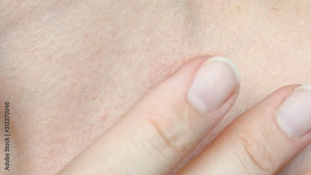 Vídeo do Stock: skin rash treatment on woman neck. Shingles, Disease ...