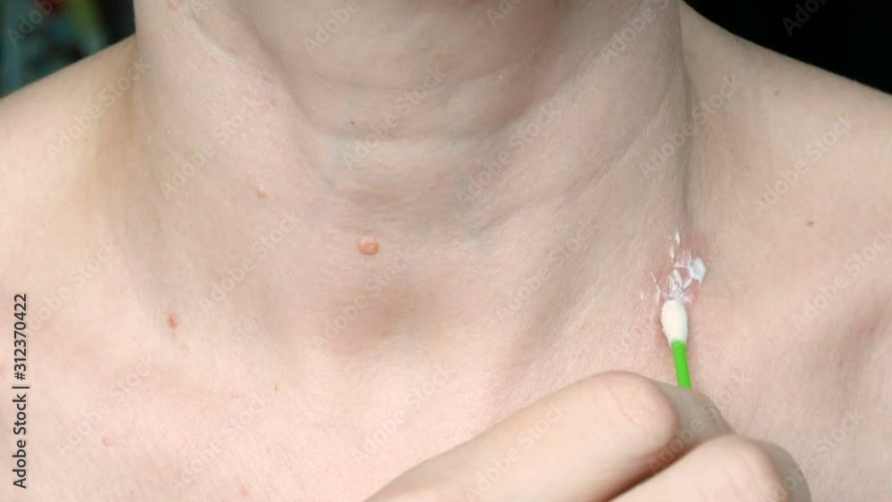 skin rash treatment on woman neck. Shingles, Disease, Herpes zoster ...