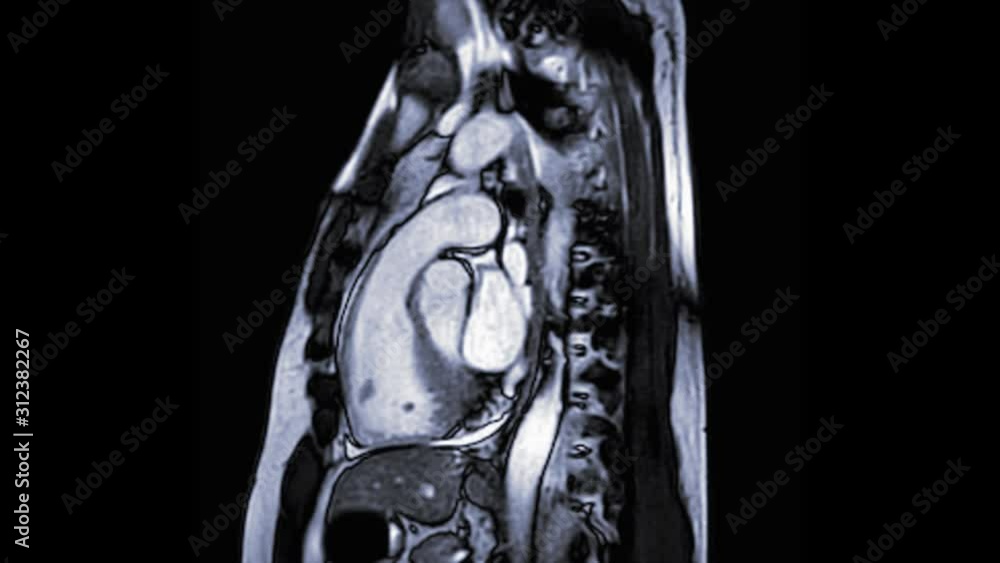 MRI heart or Cardiac MRI magnetic resonance imaging of heart in RVOT ...
