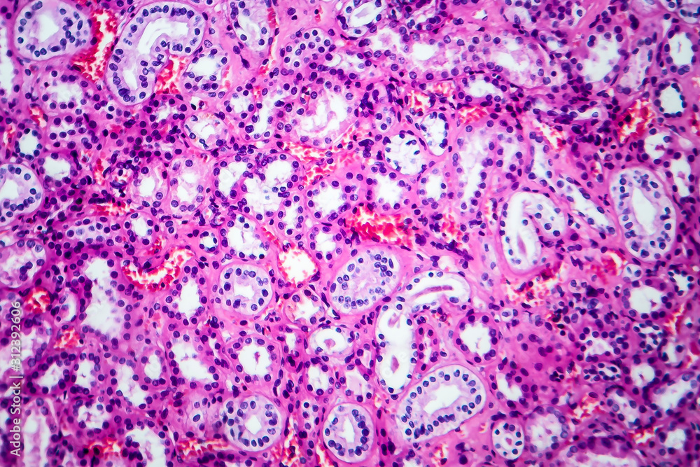 Histopathology of hypertensive renal disease, light micrograph, photo ...