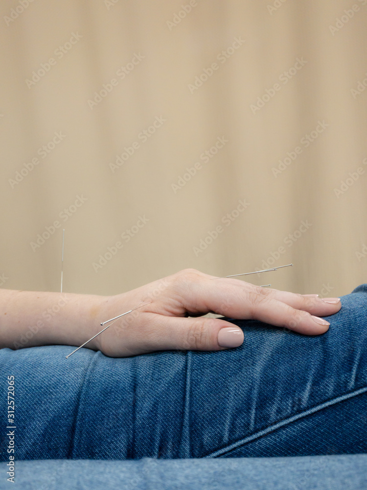 Acupuncture for hand injury Stock Photo | Adobe Stock