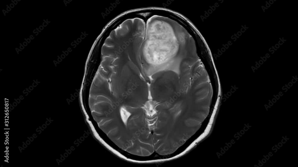 Magnetic resonance imaging (MRI) of brain, brain tumor Stock ビデオ ...