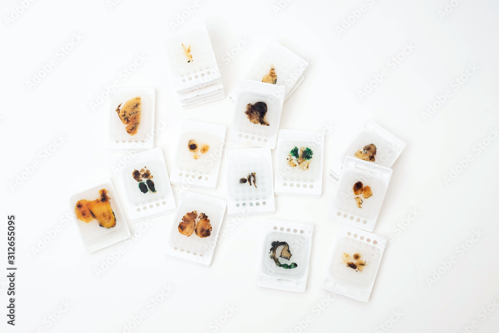 Paraffin Embedded Tissue Blocks of Cancer on iSolated White Background ...