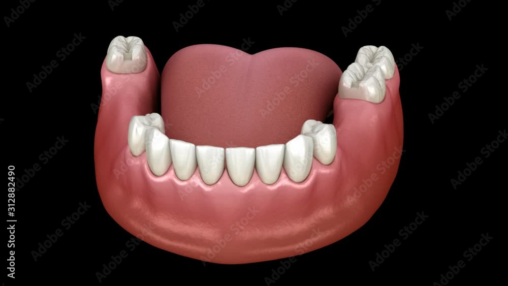 Removable partial denture, mandibular prosthesis. Medically accurate 3D ...