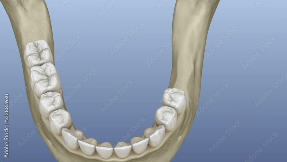 Implantation with mini implants in to recessed jaw bone: Medically ...