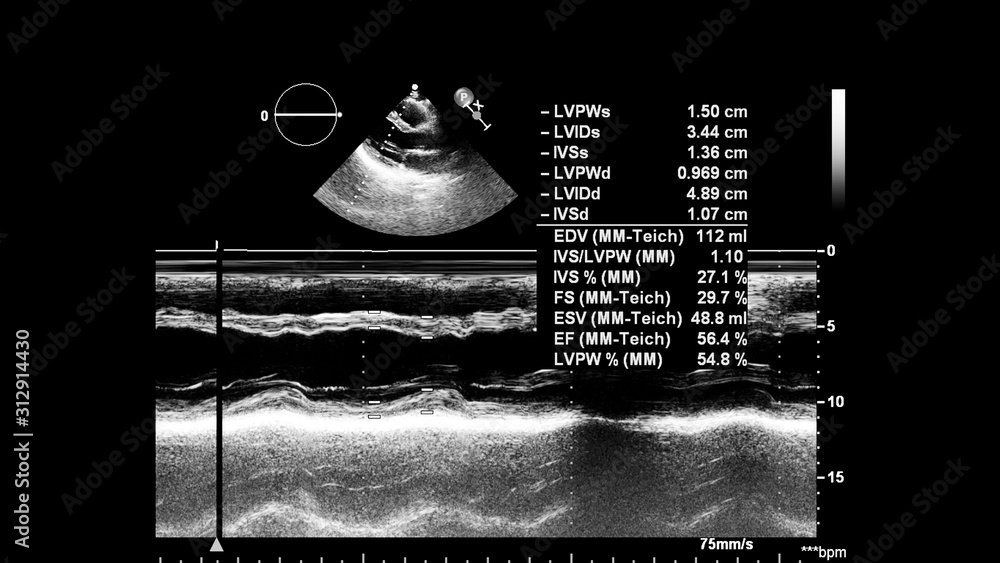 Image of the heart in gray-scale mode during transesophageal ultrasound ...