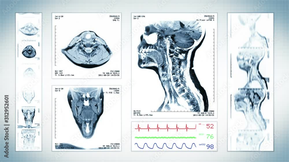 Video „Neck MRI Scan. White. 3 videos in 1 file. Animation showing top ...