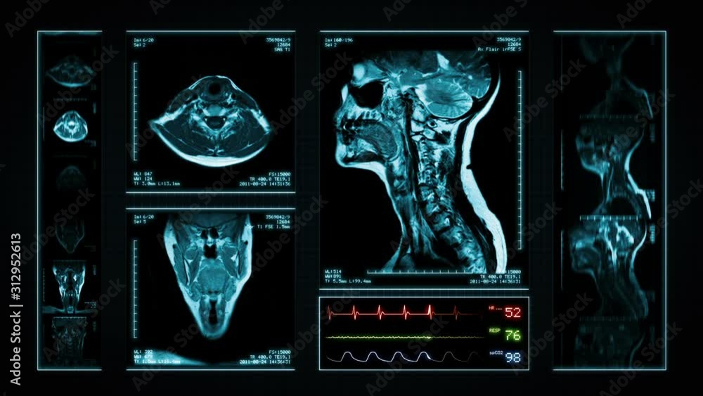 Neck MRI Scan. Blue. 3 videos in 1 file. Animation showing top, front ...