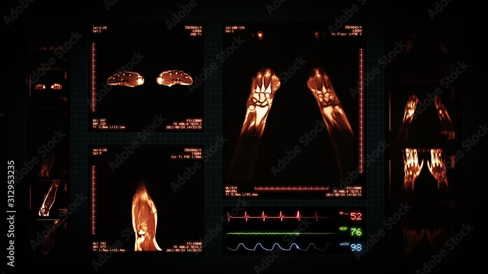 Arm MRI Scan. Amber. 3 videos in 1 file. Animation showing top, front ...