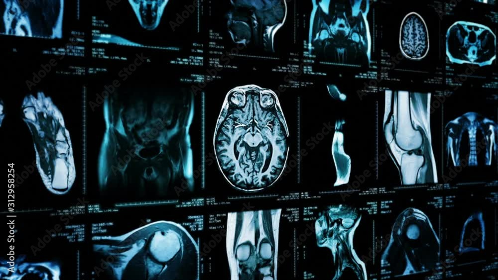 Multiple MRI video wall. Black and white. Loopable. Lateral view. 2 ...