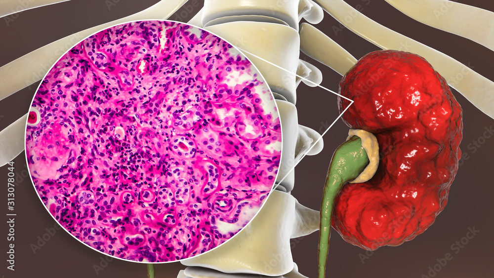 Chronic pyelonephritis, 3D illustration showing gross morphology with ...