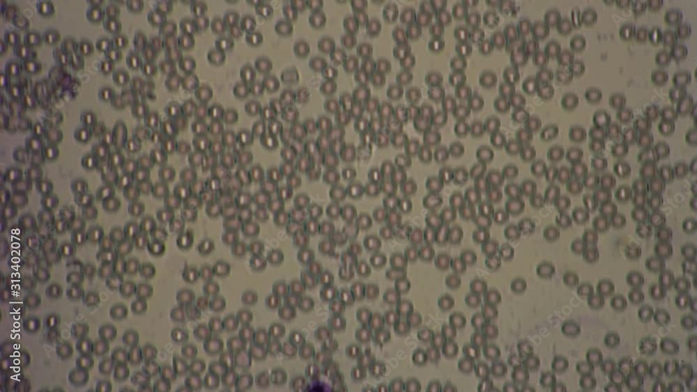 Smear of human blood red red blood cells in a microscope. Theme of ...