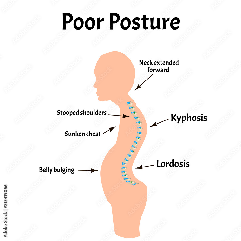 Improper posture symptoms. Text Neck Syndrome. Spinal curvature ...