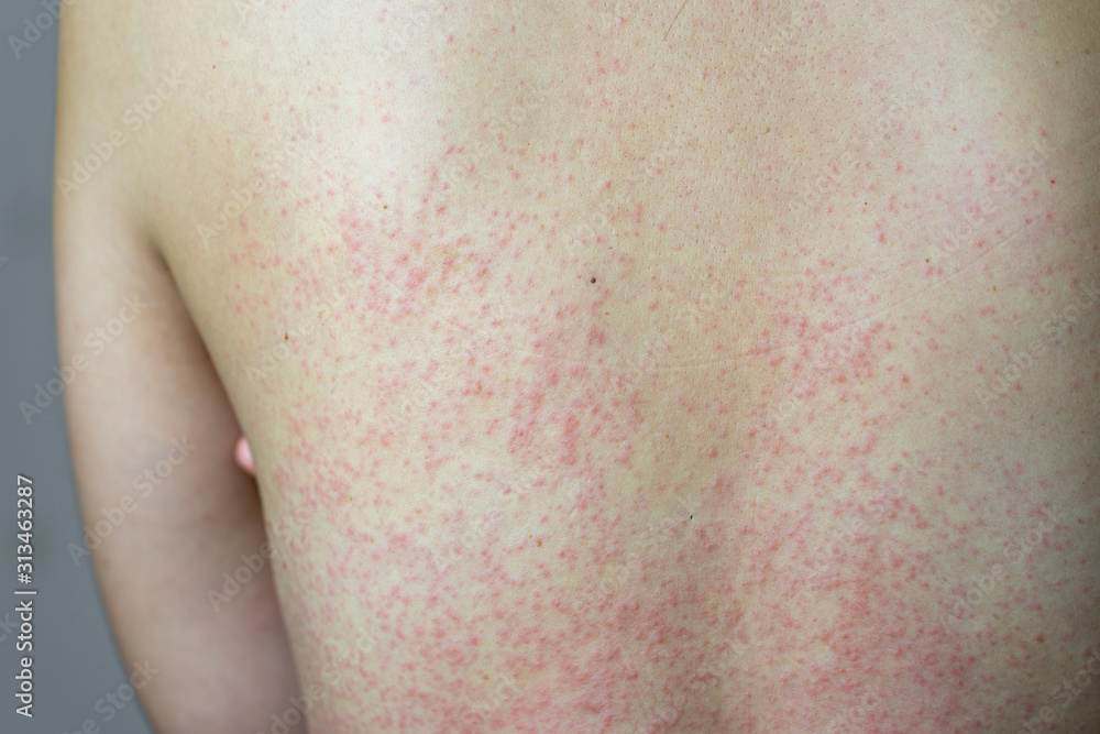 Close up Allergy rash, Around Back view of asian women with dermatitis problem of rash ,Allergy ...