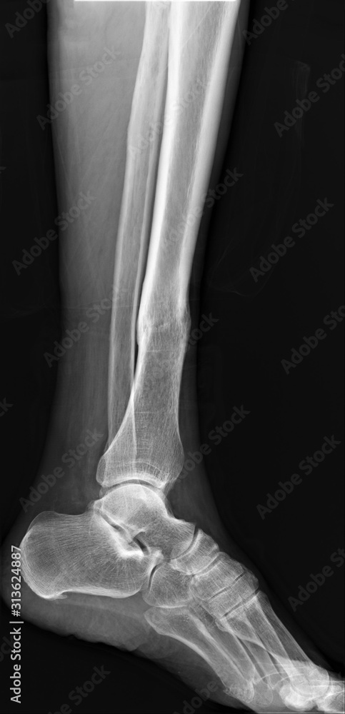 x-ray with an improperly fused tibial fracture Stock Photo | Adobe Stock