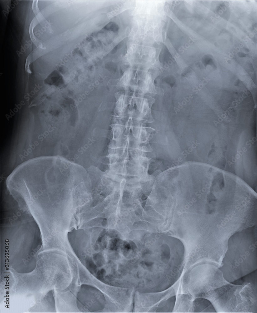 x-ray of the abdominal cavity and pelvis in direct projection, medical ...