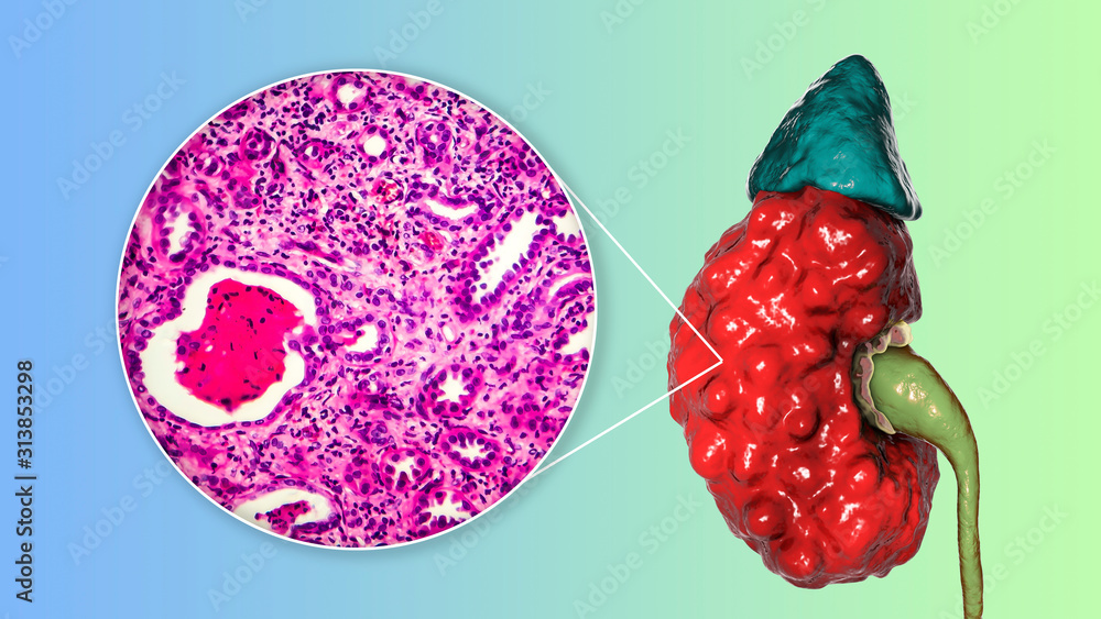 Chronic Pyelonephritis Gross