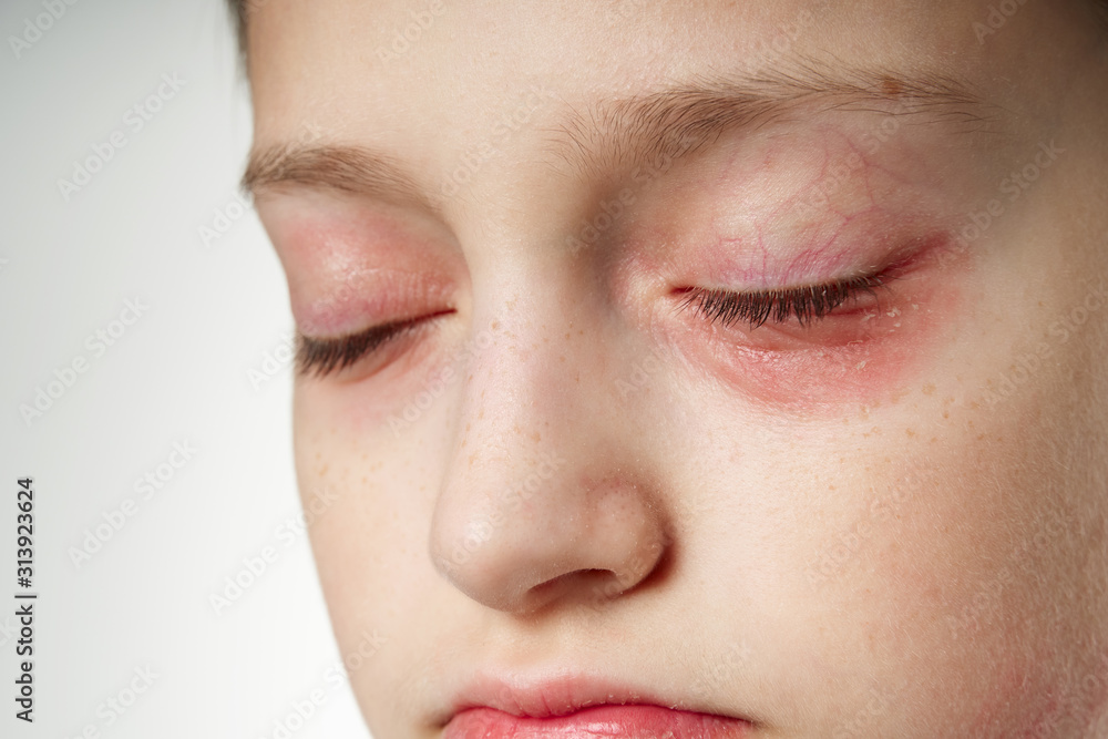 Allergic reaction, skin rash, close view portrait of a girl's face ...