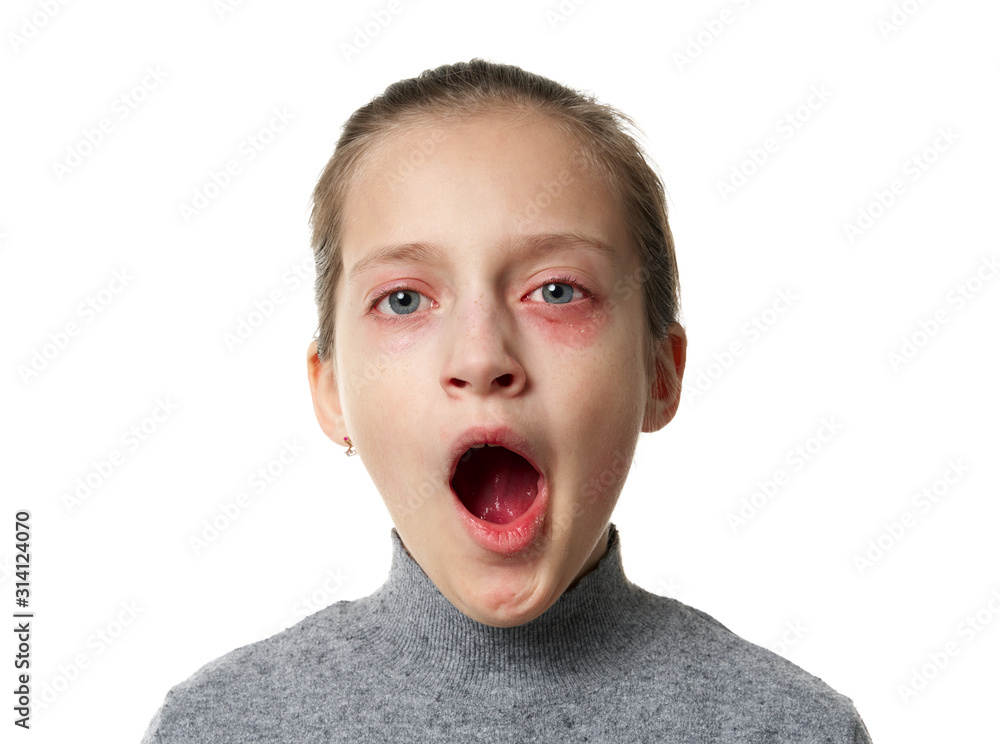 Allergic reaction, skin rash, close view portrait of a girl's face ...