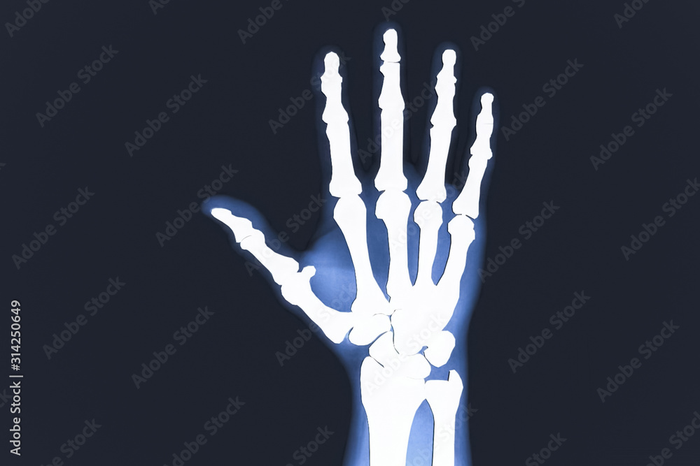 X-rayed human hand. X-ray of hand bones. Stock Photo | Adobe Stock