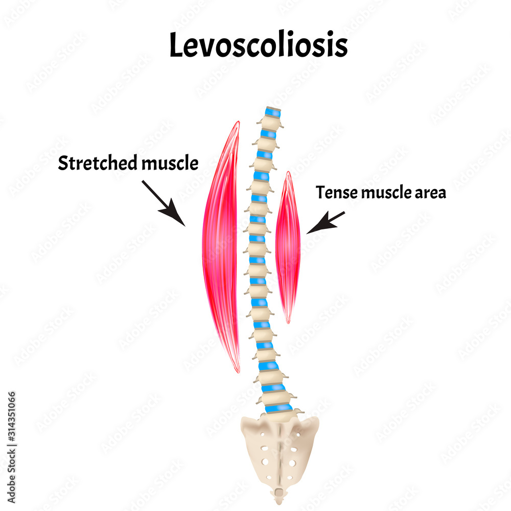 Left-sided scoliosis. Levoscoliosis. Muscles and spine. Spinal ...