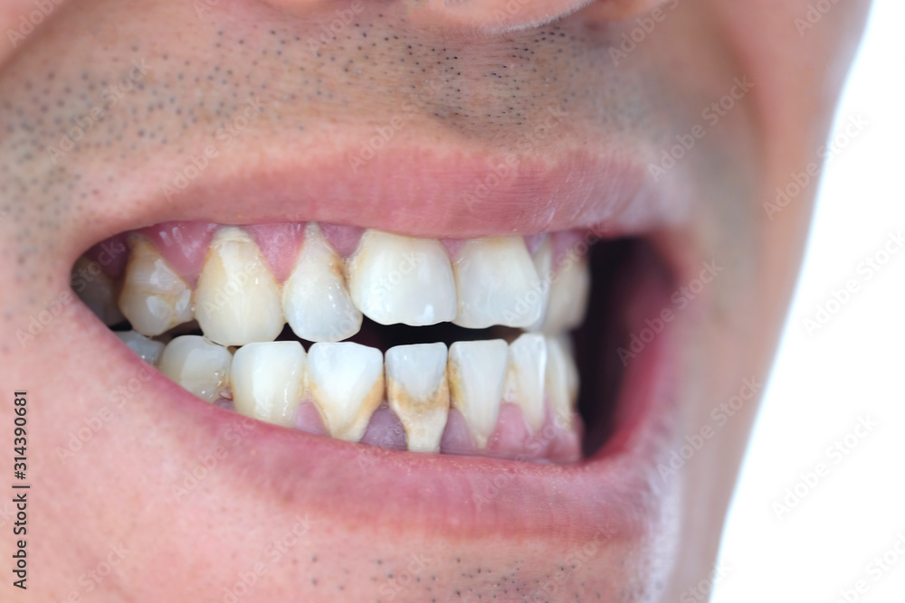 Tooth's a man smoking bad. Man smokes a cigarettes have tooth decay and ...