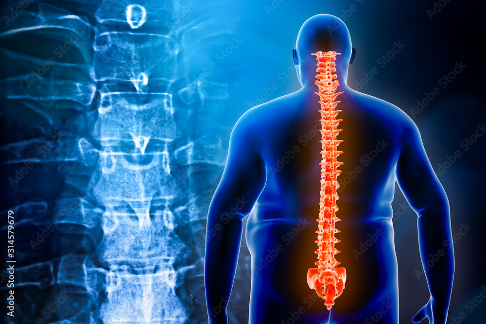 Back view of an obese man with its spine or backbone and vertebrae x ...