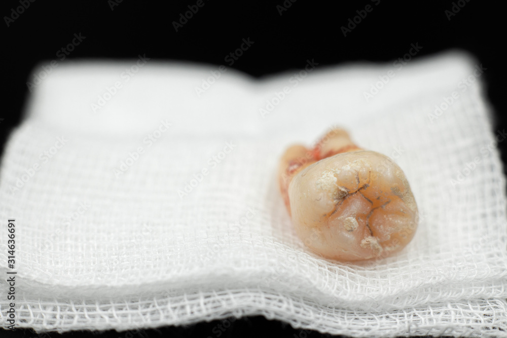 The extracted tooth is on a white gauze, Dental surgery concept, Macro ...