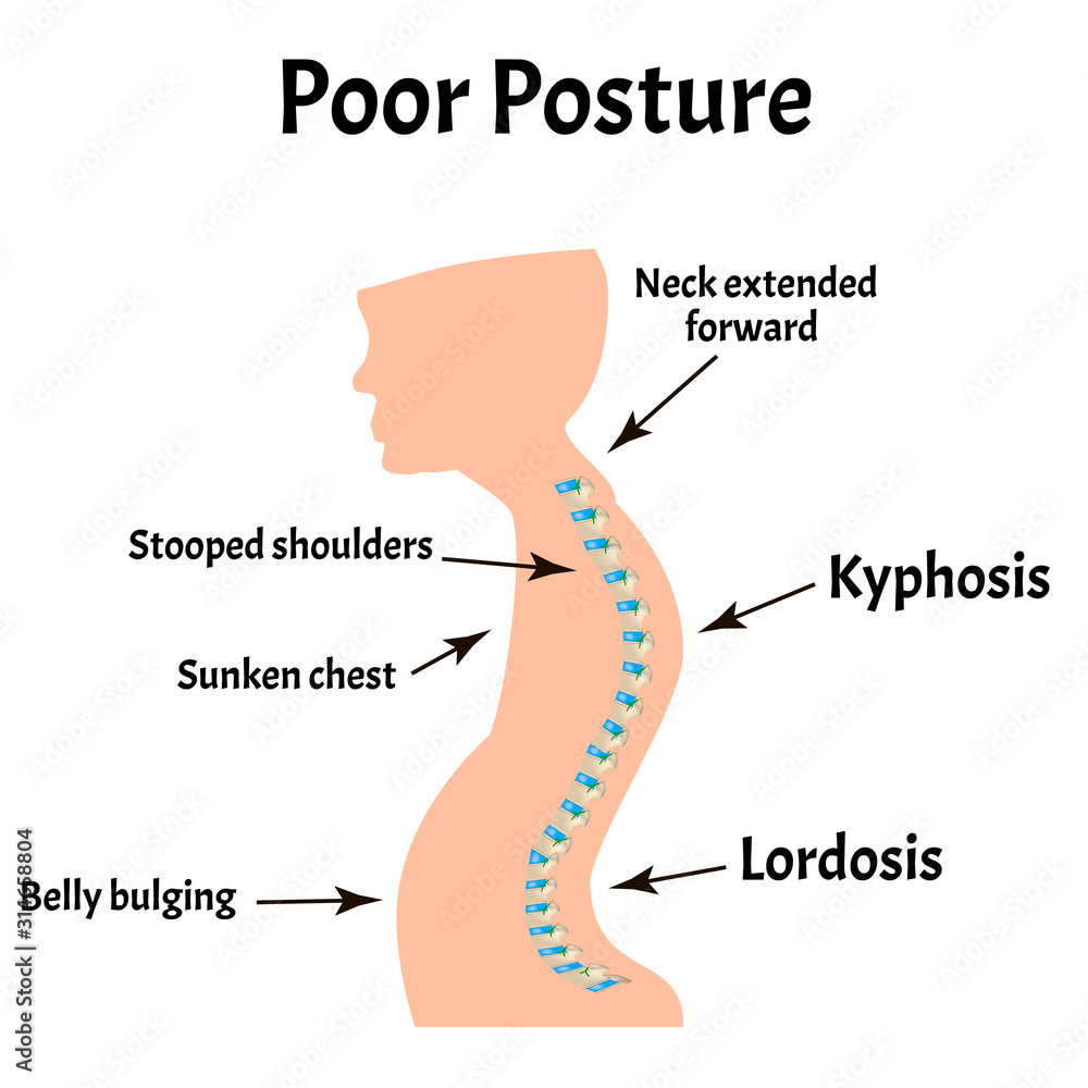 Improper posture symptoms. Text Neck Syndrome. Spinal curvature ...