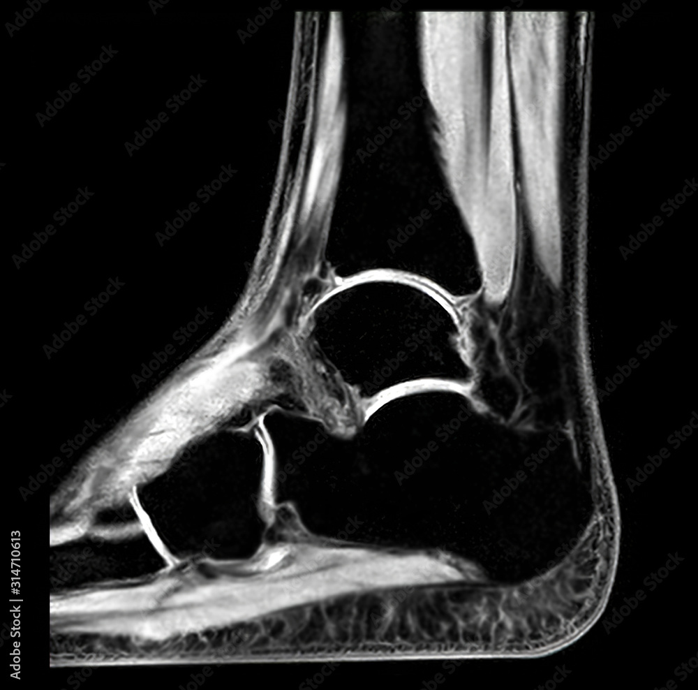 MRI Ankle Sagittal view showing black bone for diagnostic tendon injury ...