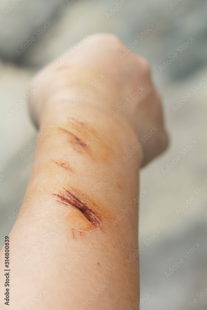 The wound form scabs on hand and arm. The wound happen during woman ...
