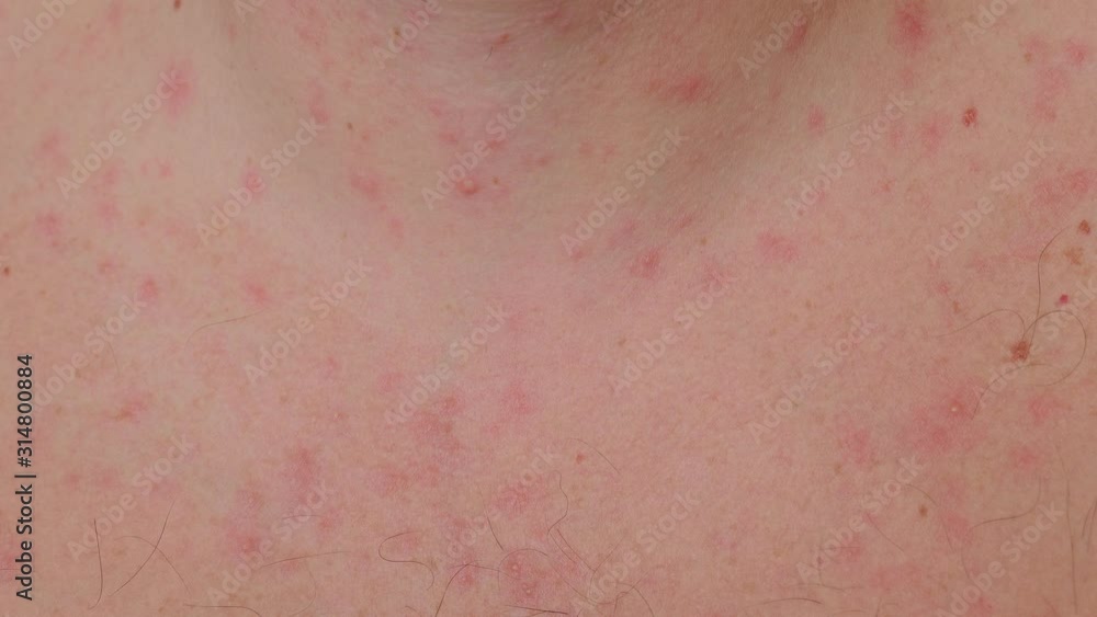 Close-up of skin with red rashes from chickenpox. The neck and chest of ...
