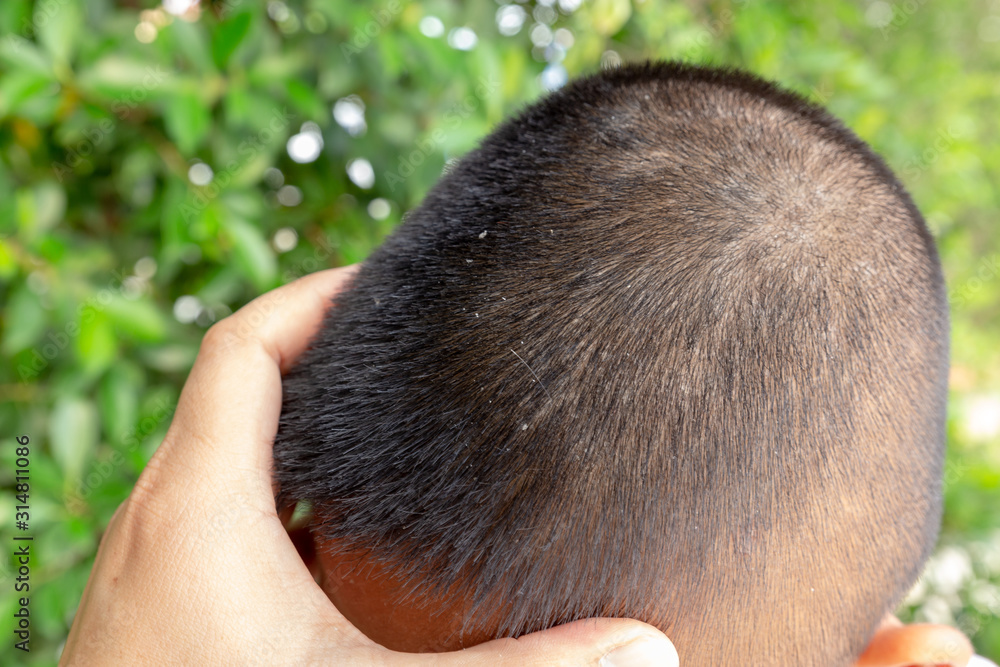 Close-up skin head , scalp, photos of dermatitis and eczema, skin ...