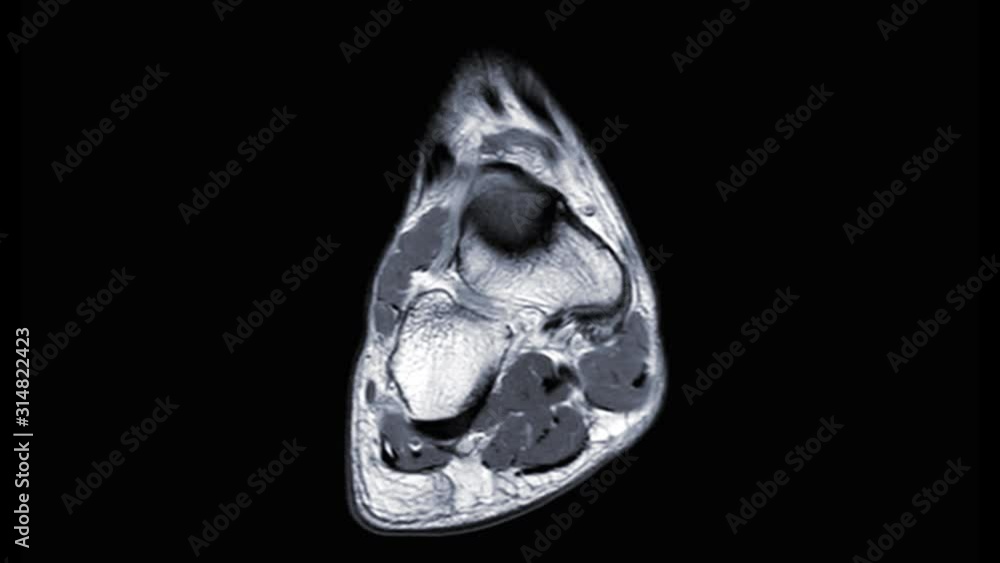 mri ankle joint coronal T2 for diagnosis tendon of ankle joint injury. Stock Video | Adobe Stock
