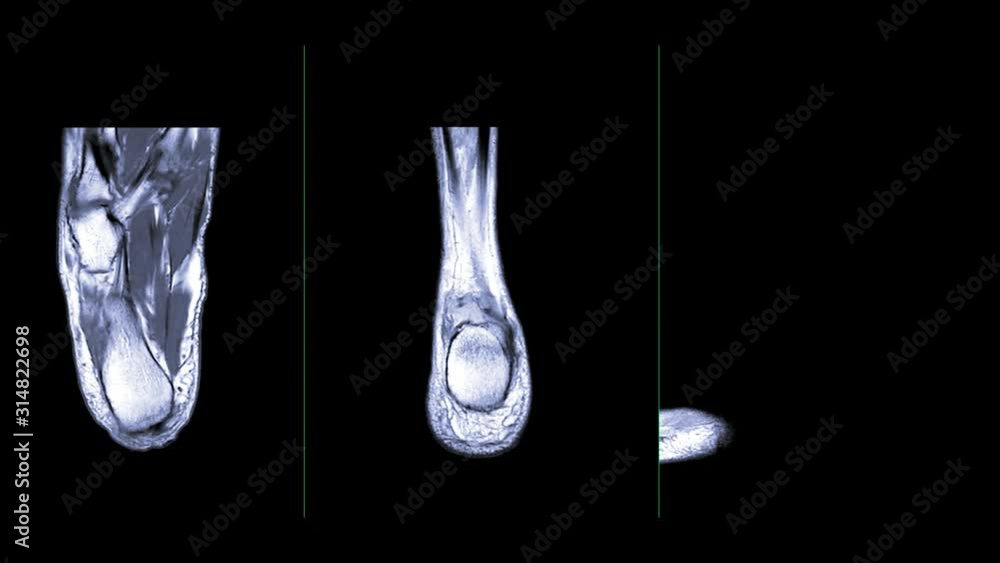Compare of mri ankle joint axial, coronal and sagittal T2 for diagnosis ...