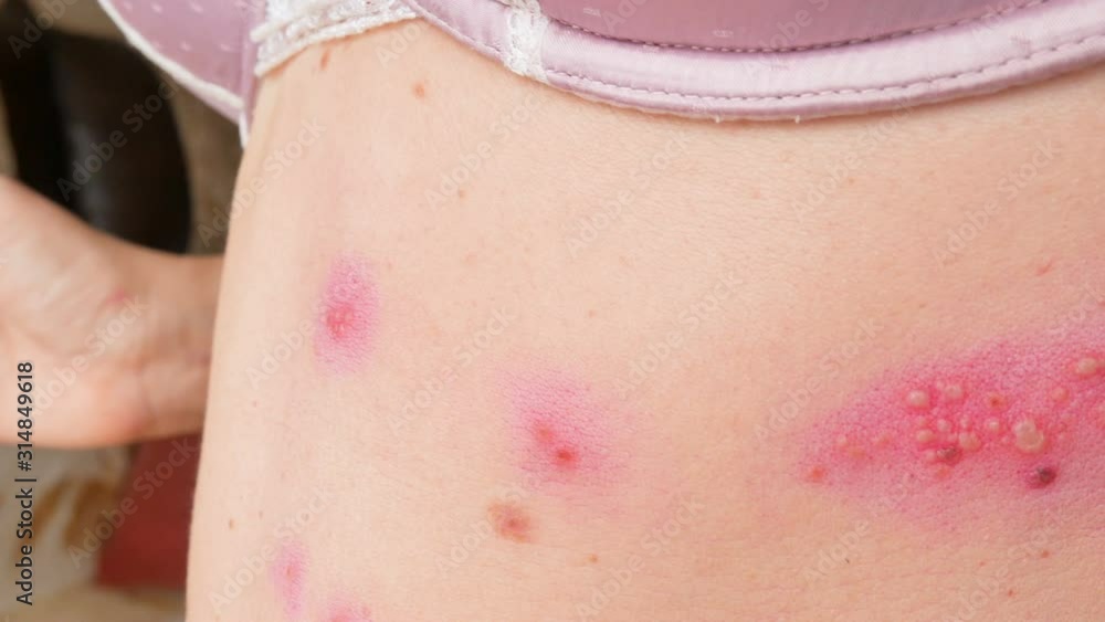 skin rash treatment on woman body. Shingles, Disease, Herpes zoster ...