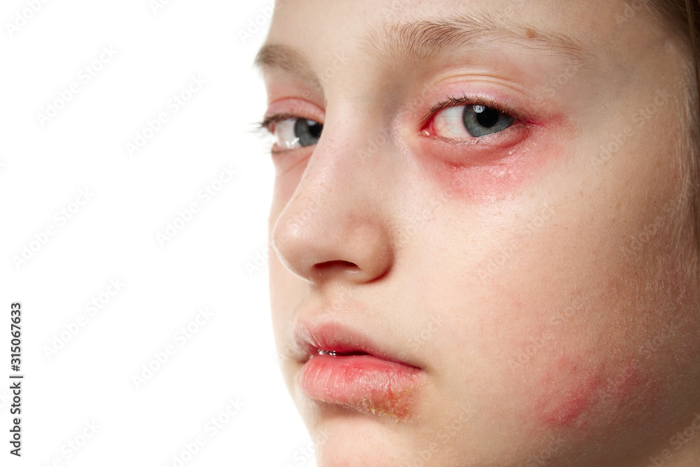 Allergic reaction, skin rash, close view portrait of a girl's face ...