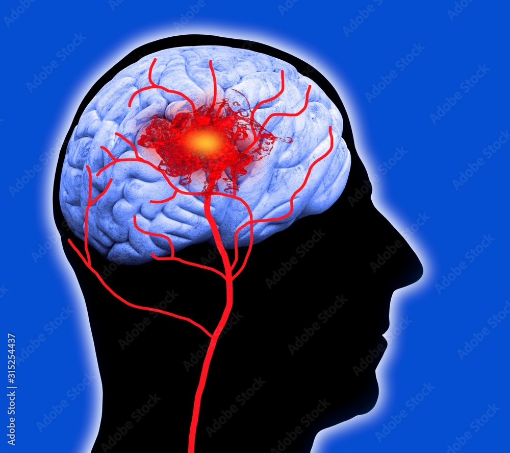 Human brain showing stroke Stock Photo | Adobe Stock
