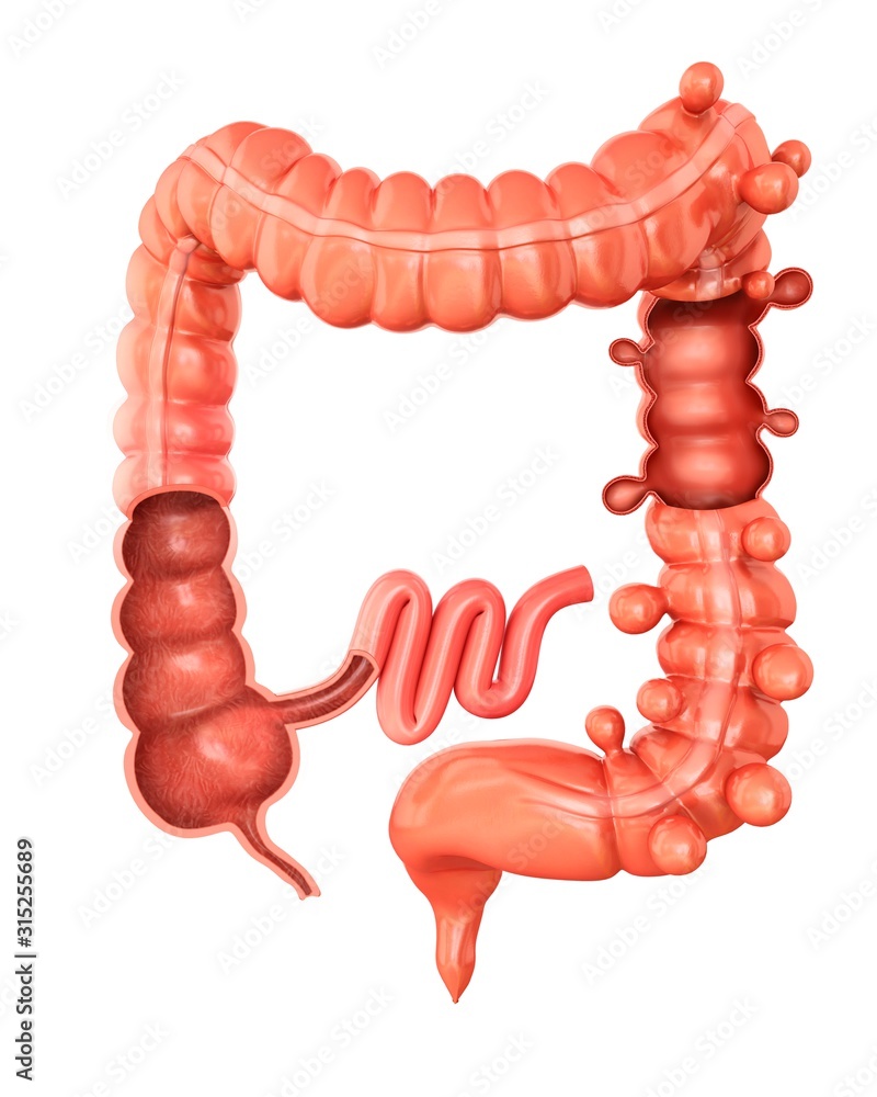 Diverticulitis, illustration Stock Photo | Adobe Stock
