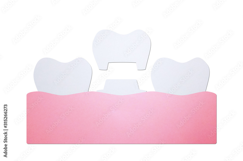 dental crown, installation process and change of teeth - tooth cartoon ...