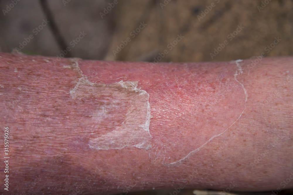 Cellulitis on leg and foot of mature diabetic man in daylight outdoors ...