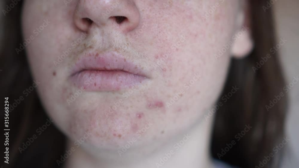 Depressed girl with acne problem, Girl checking her face in the mirror ...