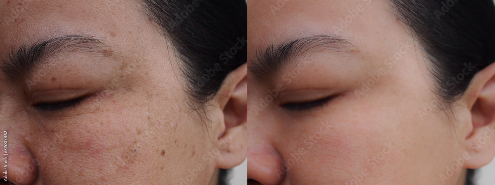 Image before and after spot melasma pigmentation facial treatment on ...